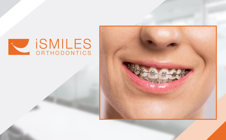 Traditional Braces in Irvine, CA | Traditional Braces Near You